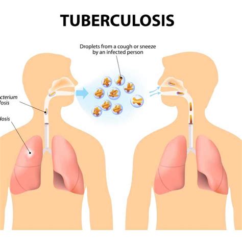 Tuberculosis Indicators Pak Kaggle