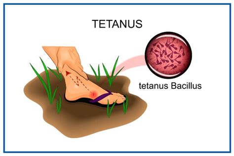 Tetanus Midwives Revision
