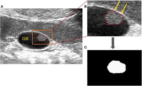 Gallbladder Polyps Ultrasound