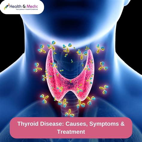 How Is Thyroid Disease Diagnosed