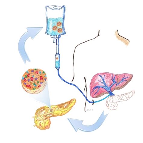 Total Pancreatectomy With Islet Autotransplant Total Pancreatectomy