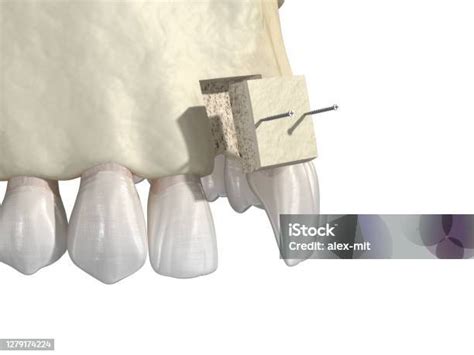 뼈 이식 뼈 치아 이식의 블록을 사용하여 확대 의학적으로 정확한 3d 일러스트레이션 감소에 대한 스톡 사진 및 기타 이미지 감소 건강관리와 의술 디지털 생성 이미지