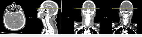 CT Angiography Of The Brain Showing No Acute Large Vessel Occlusion Download Scientific Diagram