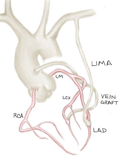 Acute Subclavian Artery Thrombosis Causing Acs In 2025 Cath Lab Nursing Arteries Anatomy