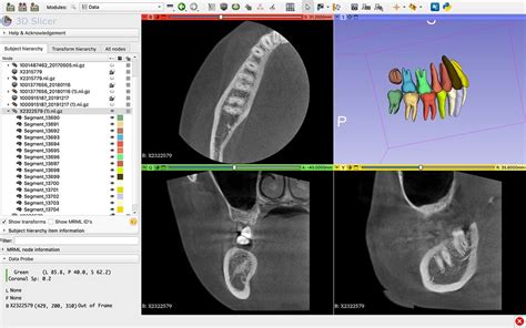 A Problem Of Showing Up The Segmentation When Loading Support 3d