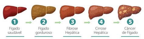Fígado Saudável Gastroclínica Florianópolis