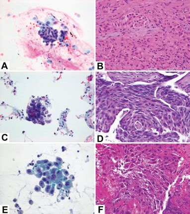 Subtyping Of Non Small Cell Lung Carcinoma A Comparison Of Small