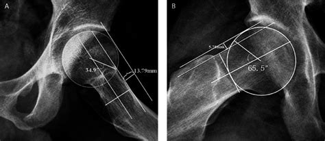 Frog Leg Lateral Radiograph Of The Normal And Abnormal Hip Joint A