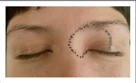 Structure Of Infratrochlear Nerve Semantic Scholar
