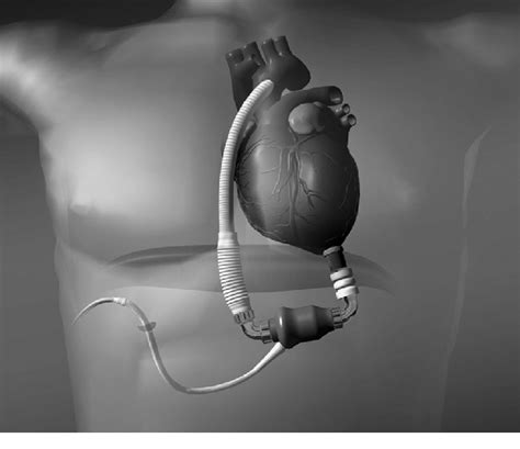 Heartmate ® Ii Left Ventricular Assist System Courtesy Of Thoratec