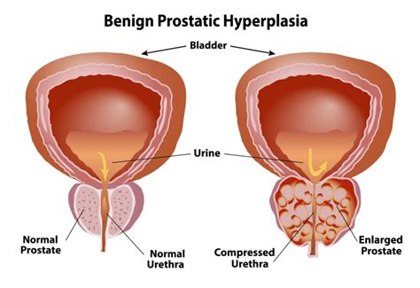 Bph Vs Prostate Cancer American Prostate Centers