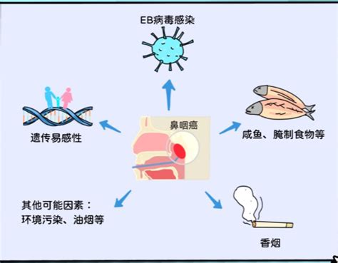 健康科普 认识 鼻咽癌” 知乎