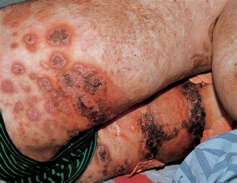 坏疽性脓皮病 临床皮肤病学