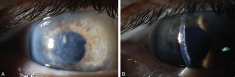 Corneal Edema After Cataract Surgery Clinical Tree