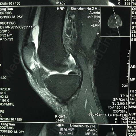 右髌骨外伤性脱位，髌股内侧韧带断裂 医联