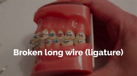 Ask Us Problems With Your Brace Herts Orthodontics In Hertfordshire