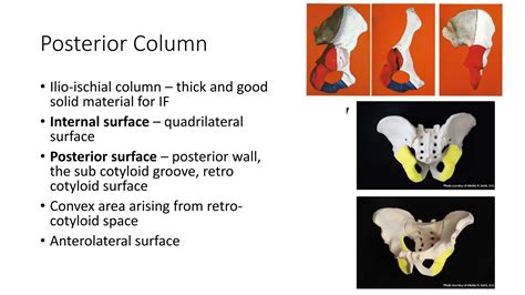 Acetabulum Fractures Anatomy Radiological Evaluation Classification And Management Pptx
