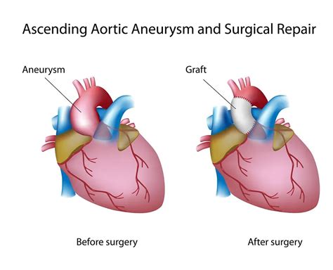 Aortic Root Reconstruction Heartplace Cardiovascular Disease Specialists And Cardiac