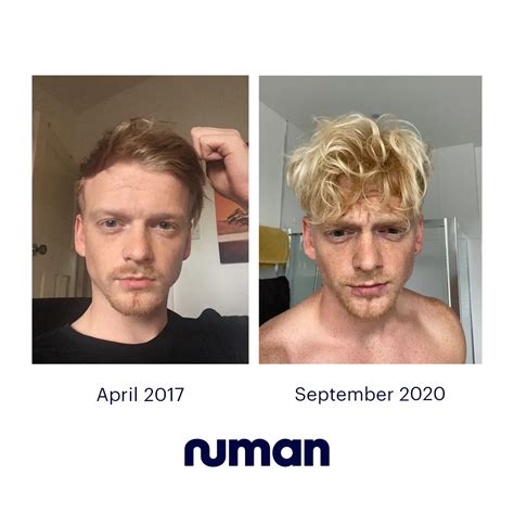 Thomas Hair Regrowth Story