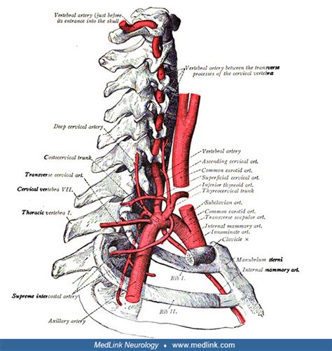 Carotid Subclavian Transposition