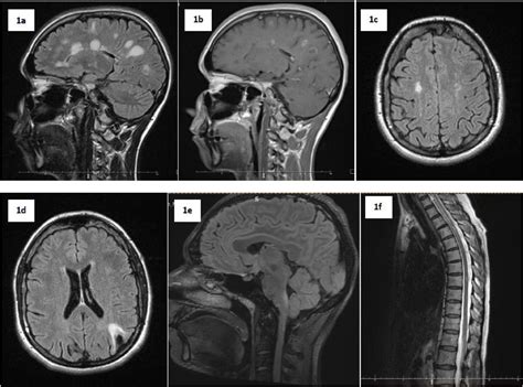 Differential Diagnosis Of Multiple Sclerosis And Other Inflammatory Cns Diseases Multiple