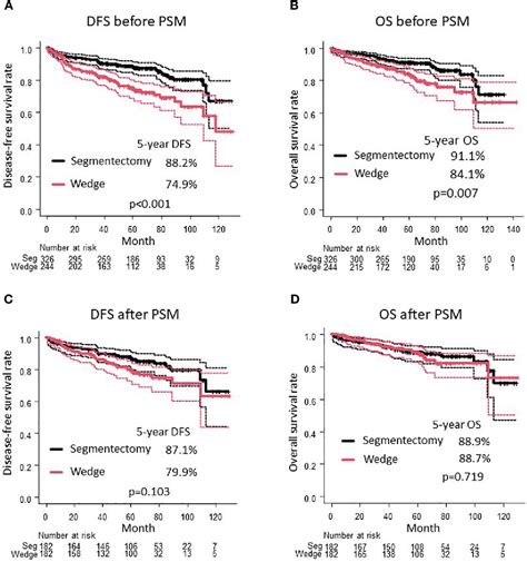 Figure 2 From Wedge Resection Vs Segmentectomy For Lung Cancer Measuring ≤ 2 Cm With