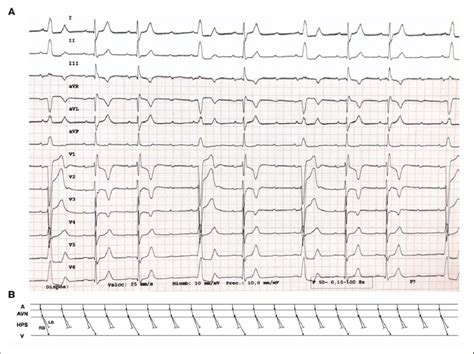 Recorded Episodes Of 2 1 And Advanced Atrioventricular Block A