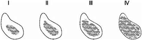 Classification Of Bone Quality According To Lekholm And Zarb 12 I Download Scientific