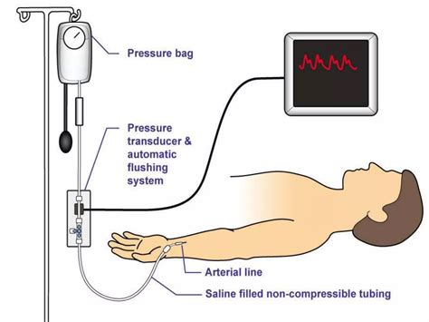 Introduction To Icu Basics In Icu Pptx