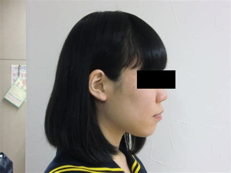 症例（51） 浜松市で矯正治療の期間のご相談ならいとう歯科矯正歯科ティースエクセレントクリニックへ