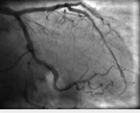 Post Pci Lm Stent Into Proximal Lad With Timi 3 Flow And Excellent