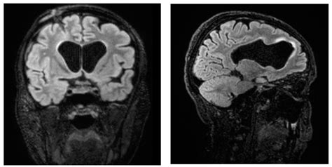 Enterococcus Faecalis Infection