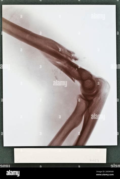 Broken Arm X Ray Showing A Fractured Upper Arm Bone Humerus This X
