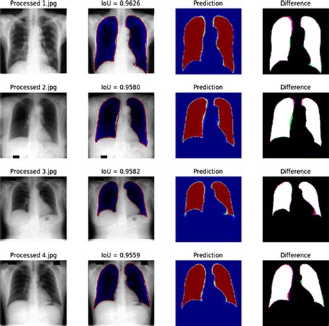 Segmentation Of Lung From Public Database Based On U Net Download