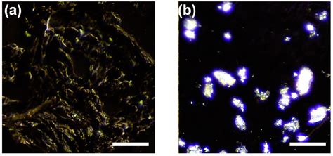 Cholesterol Crystals In Urine Polarized