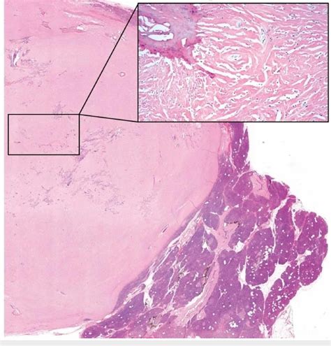Figure 1 From Calcifying Fibrous Pseudotumor Of The Pancreas In A Patient With Metastatic