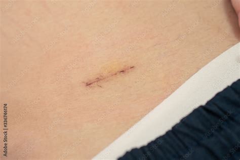 Fresh Appendix Surgical Wound After Suture Removal In Appendectomy Surgery Patient Recover In