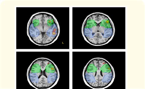 Fmri Activation Map Adt Selected Axial Cuts Displaing The Fmri Download Scientific Diagram