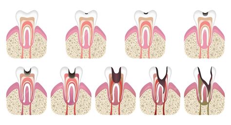 Premium Vector Stages Of Caries Development Tooth Structure In Flat