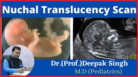 Nuchal Translucency Scan Anti Scan Test FWB Part 2 Chromosomal Scan Deepak PD Singh