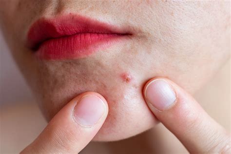 Acne Nodule Vs Cyst