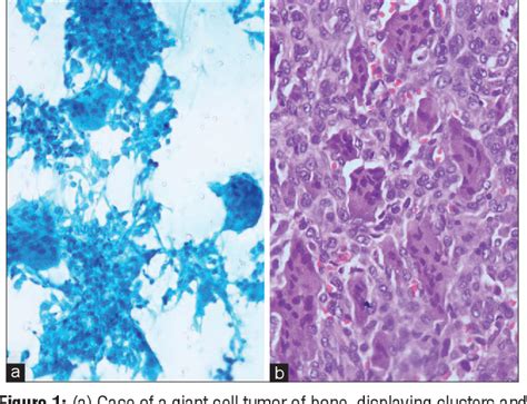 Figure 1 From Core Needle Biopsy Versus Fine Needle Aspiration Cytology