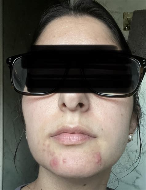 Diagnosed With Rosacea In April And Have Been On 40mg Doxycycline And Tacrolimus Ointment Daily