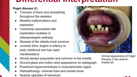 Fibrous Dysplasia Types