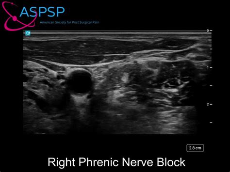 Arun Kalava M D Edra On Linkedin Ultrasound Guided Phrenic Nerve Block 💉for Hiccups