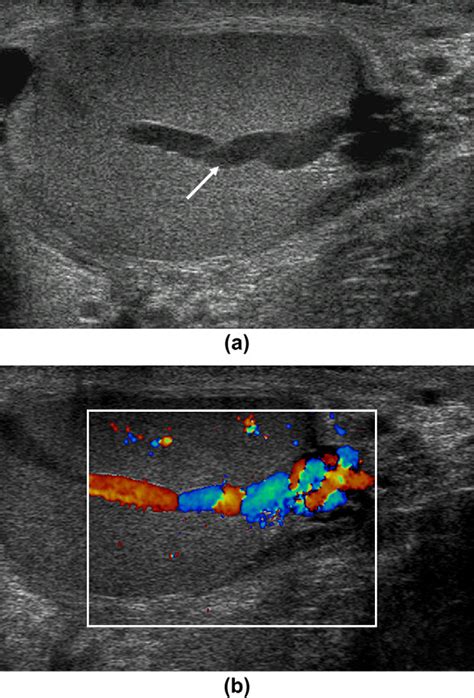 Varicocele Ultrasound