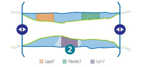 Learn How To Ivus With This Simple Workflow Boston Scientific