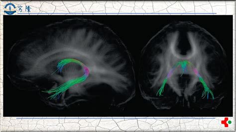 脑白质纤维束的dti表现 脑医汇