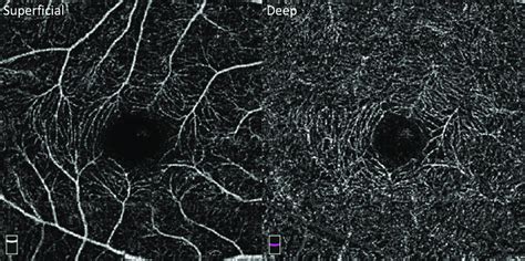 3mm X 3mm OCT A Imaging Of The SCP And DCP Using Optovue RTVue XR Download Scientific Diagram