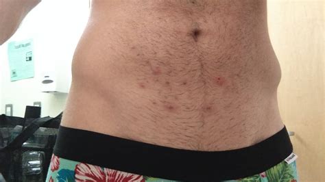 Cant Get Rid Of Ingrown Hairs R Askdocs